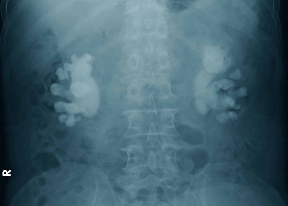 The Four Most Common Types of Kidney Stones - Evan R. Goldfischer, M.D ...